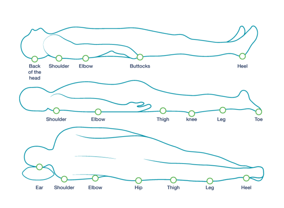 WHERE DO PRESSURE INJURIES OCCUR? | ActivHeal® Academy