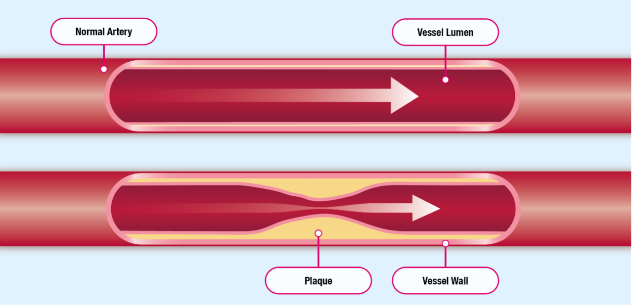 Arterial Leg Ulcers | ActivHeal® Academy